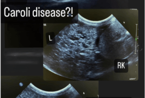 Understanding Caroli Disease, What It Is, Symptoms, and How to Manage ...